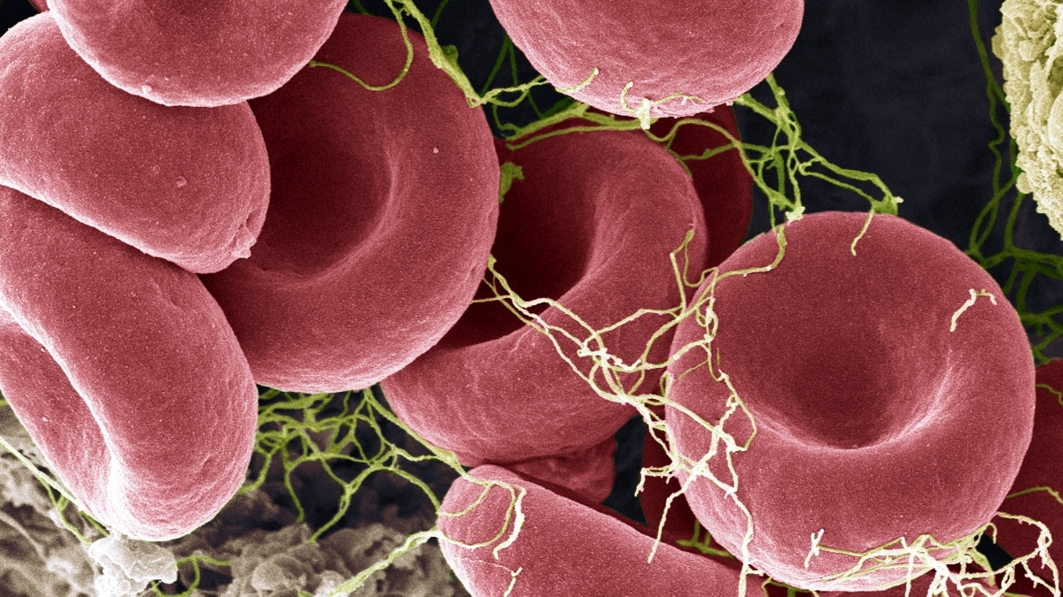 New Blood Test Shows Promise in Detecting ME/CFS